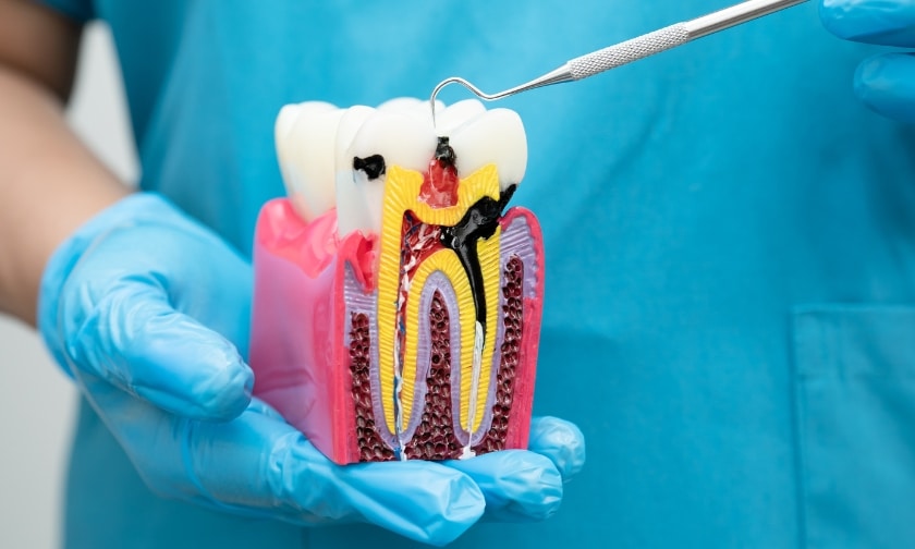 Root Canal Treatment: Save Your Natural Tooth